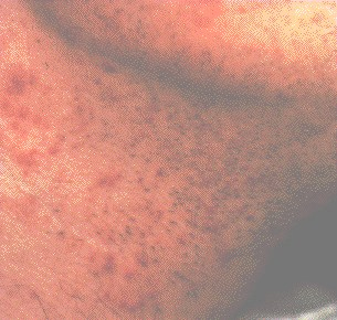 What is Folliculitis?